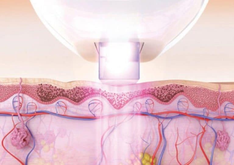 IPL Photorejuvenation - Martha E. Stewart, MD, LLC