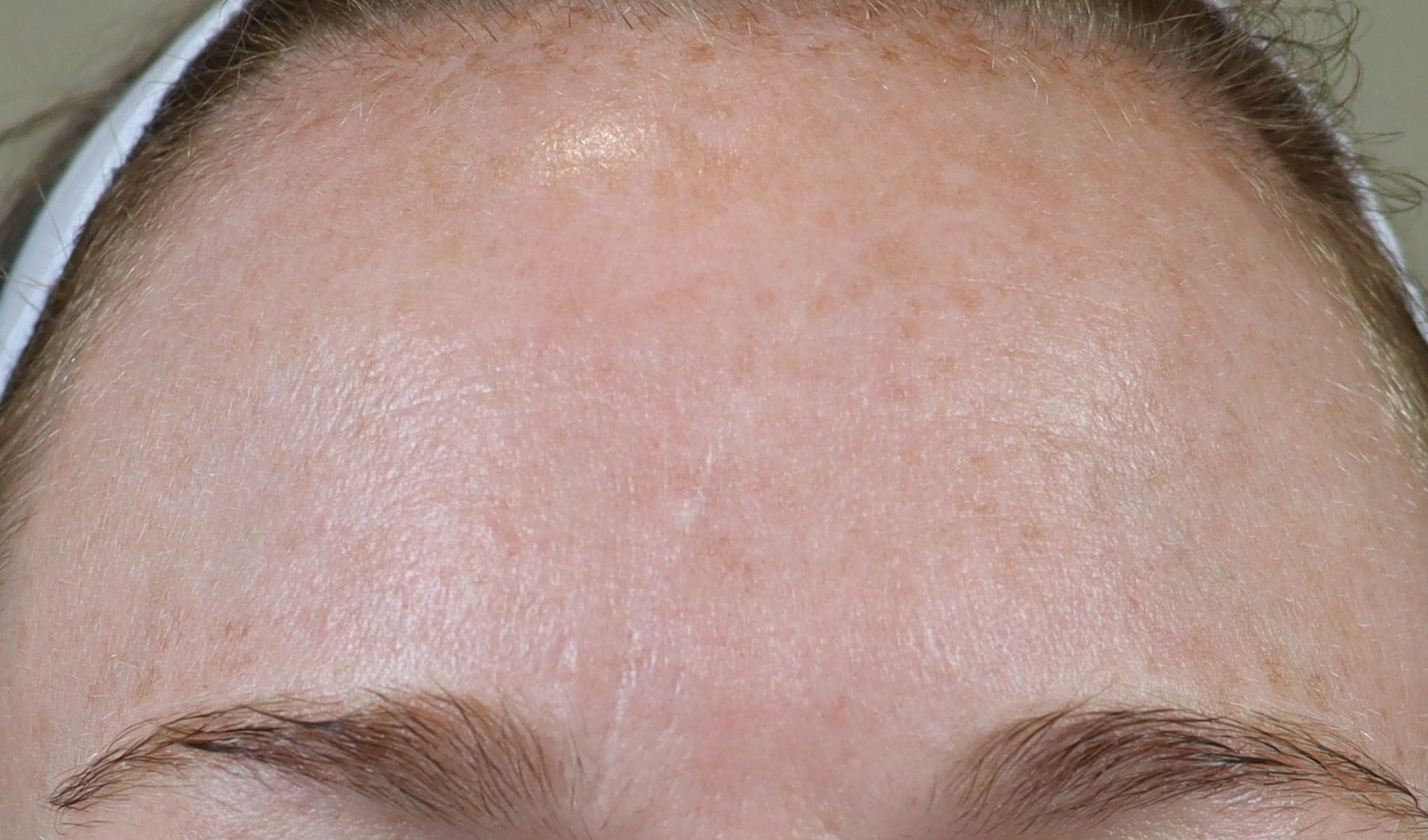 IPL Archives - Martha E. Stewart, MD, LLC