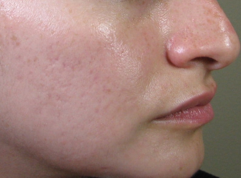 IPL Archives - Martha E. Stewart, MD, LLC